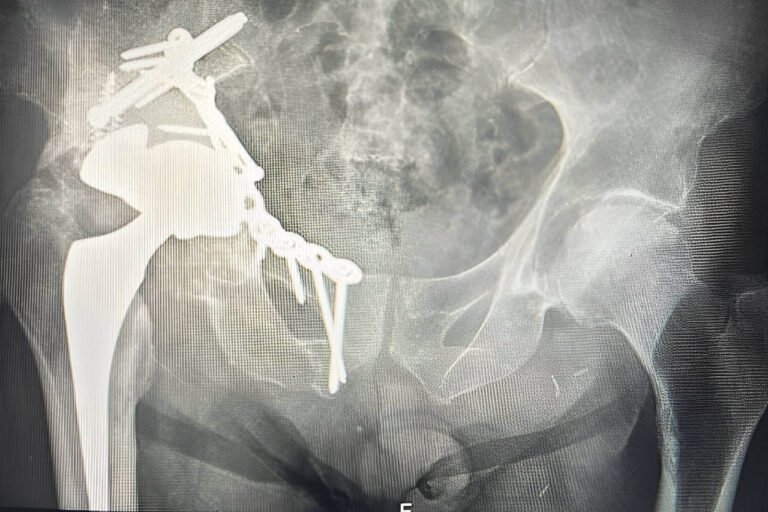 Complex Total Hip Replacements - HIP & KNEE SURGEON